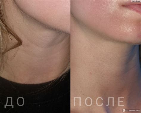 Крем для проблемной кожи Retino-A Третиноин - «Легендарный ретинол! 6 ...