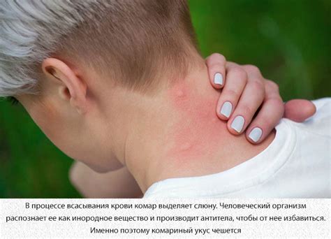 Средства после укусов комаров для снятия зуда и покраснений у детей и ...