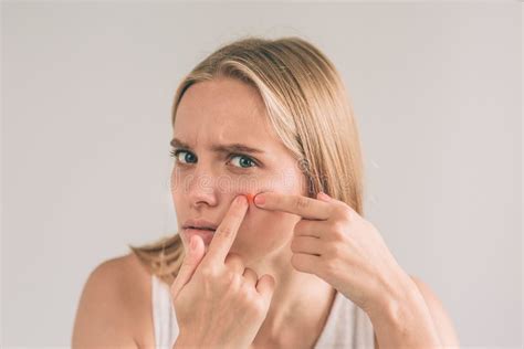 Acne Treatment. Acne Woman. Young Woman Squeezing Her Pimple, Removing ...