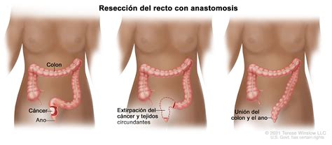 Tratamiento del cáncer de recto