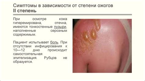 Ожоги. Термические и химические ожоги - презентация онлайн
