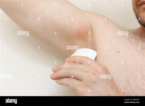Young man with irritation, inflammation on sensitive underarm skin, using deodorant or ...