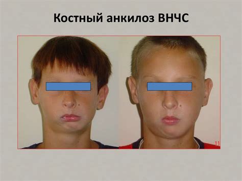 Острая травма ВНЧС у детей. Отдаленные последствия травмы ВНЧС ...
