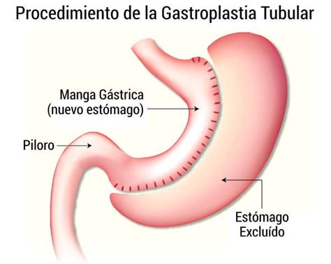 Todo sobre la gastrectomía y sus efectos: Gastroplastia tubular y crecimiento estomacal - Neurat