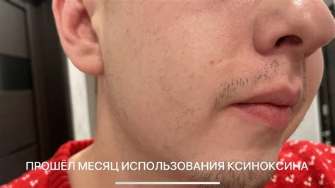 РЕЗУЛЬТАТ МИНОКСИДИЛА//КСИНОКСИНА ЗА 1 МЕСЯЦ - YouTube