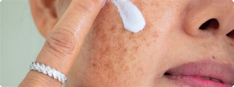 Hydroquinone Before And After Black Skin