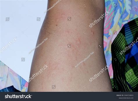 2 Urticarial Rash Feet Images, Stock Photos, 3D objects, & Vectors ...