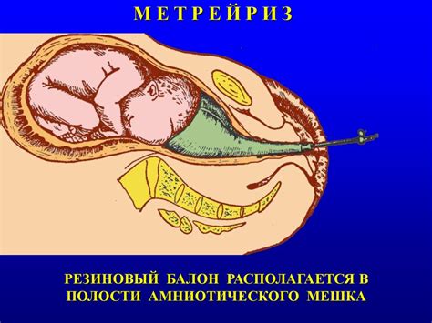 Кесарево сечение в акушерской практике - презентация онлайн