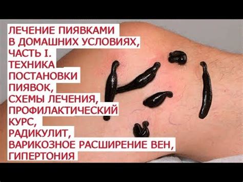 Лечение пиявками в домашних условиях, часть I Техника постановки пиявок ...