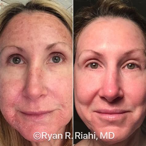 Wrinkled Skin From Sun Damage