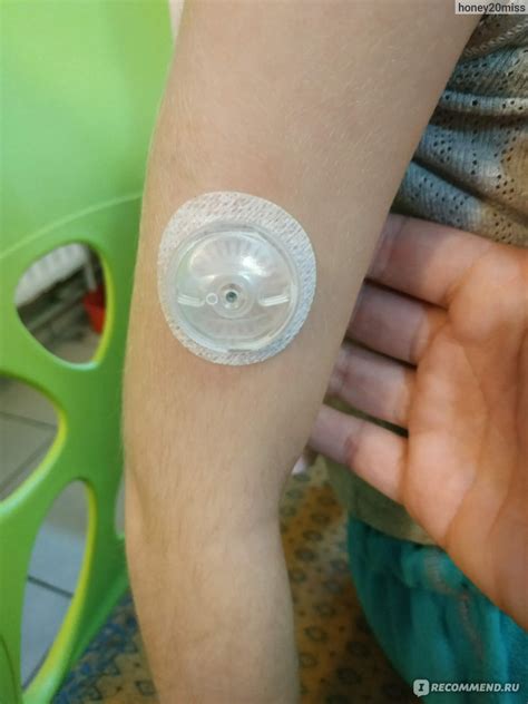 Порт для инъекций инсулина Medtronic I-port Advance - «Ручная помпа и ...