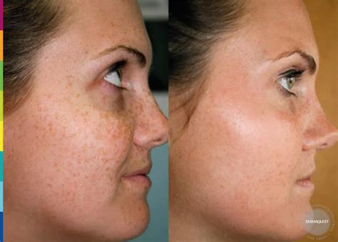 DERMAQUEST » Удаление пигментных пятен на лице лазером| Статьи | Отзывы ...