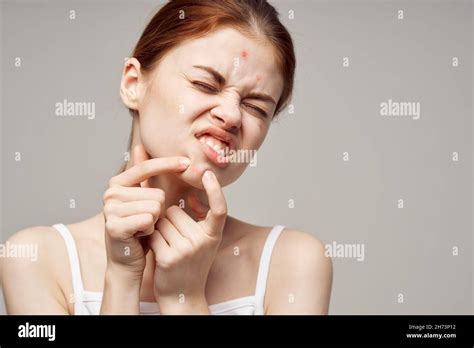 red-haired woman with pimples on the face hygiene isolated background Stock Photo - Alamy