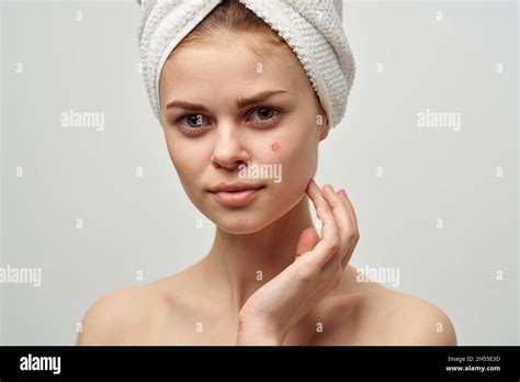 beautiful woman with a pimple on the face dermatology isolated background Stock Photo - Alamy
