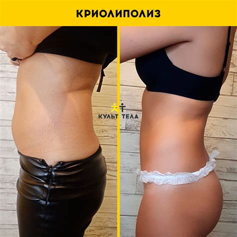 Криолиполиз цена в Москве на процедуру