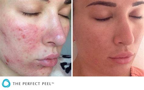 The Perfect Peel® | Renew Medical Aesthetics - Cheshire Clinic