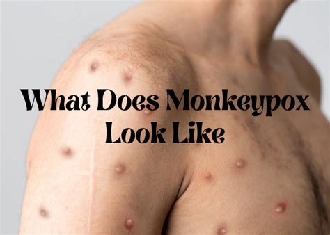 What Does Monkeypox Look Like - Techvtimes