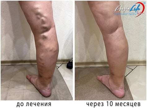 Results of treatment of varicose veins | Photos before and after