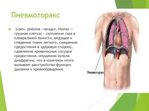 Пневматоракс и его виды. Опасность проникающих ранений грудной клетки ...