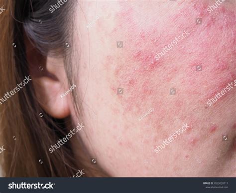 6,219 Skin Strain Images, Stock Photos & Vectors | Shutterstock