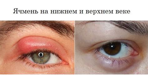 Ячмень на глазу: схема лечения в домашних условиях (отзывы, фото)