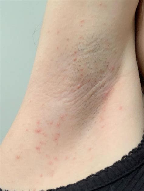 Underarm rash using any roll-on deodorant : r/Hyperhidrosis