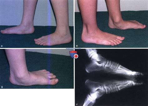 Пяточно-вальгусная стопа (pes calcaneovalgus): атлас фотографий
