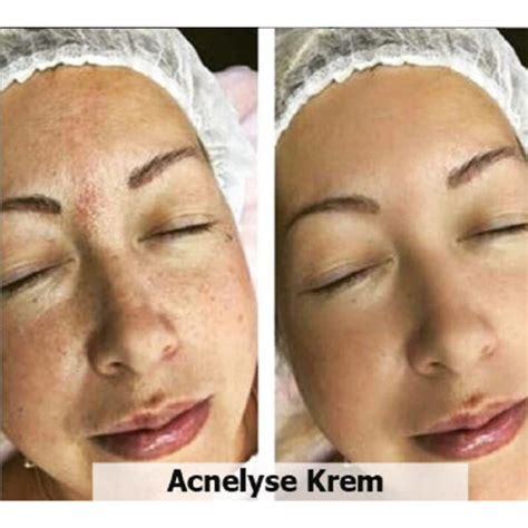 ACNELYSE Skin Cream Acne Treatment Retinoic Acid 0.1% on OnBuy