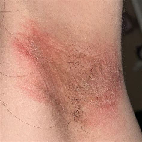 What’s going on with my armpit? : r/DermatologyQuestions