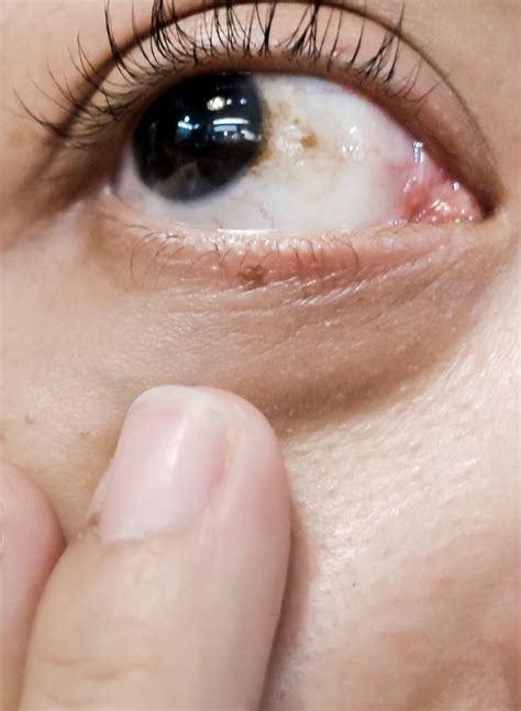 Eye Bags | B-Spoke by Dr Faisal Salim | Dubai Plastic Surgeon
