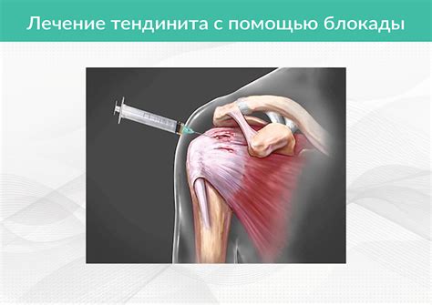 ᐈ Лечение тендинита в Москве ~【Клиника Традиция】