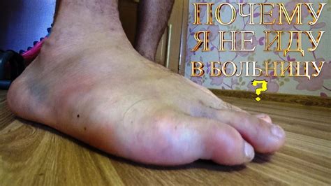 7 дней после перелома ступни без медицинской помощи! - YouTube