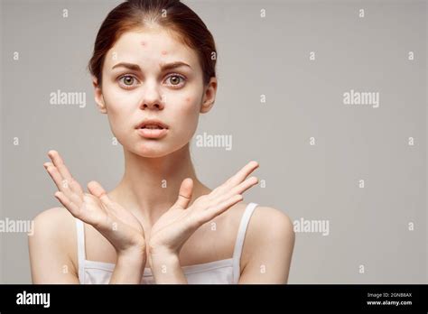 pretty woman with pimples on the face hygiene light background Stock Photo - Alamy