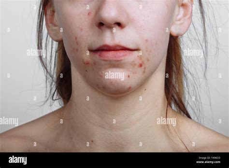 Young women with problematic skin and pimples on her face. Feamle ...