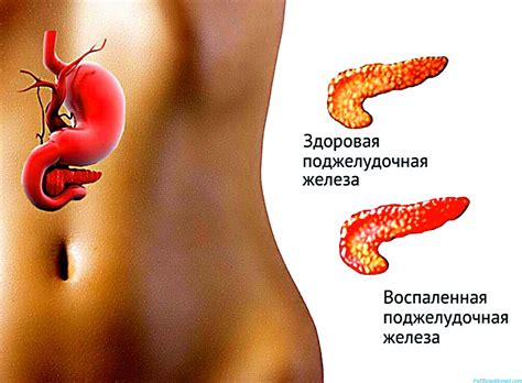 Заболевание поджелудочной железы: симптомы и лечение. Диета при ...