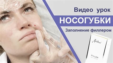 Носогубки - заполнение филлером Принцесс Филлер, контурная пластика ...