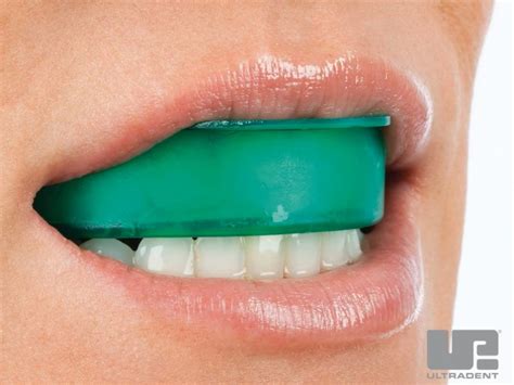 Opalescence GO 6% Teeth Whitening Trays - Smiles By Natasha