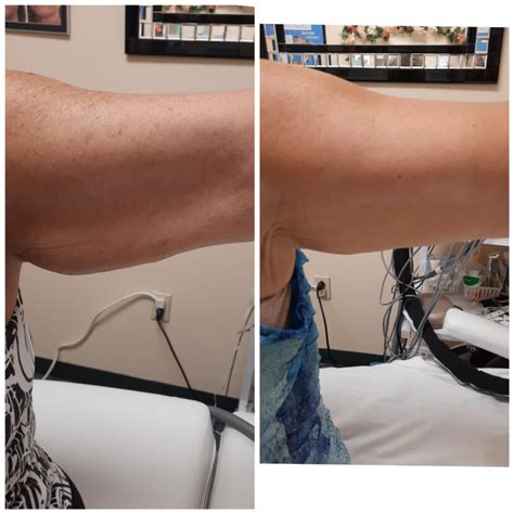 Lipo Laser vs. Liposuction: Exploring Non-Invasive Fat Removal and Skin ...