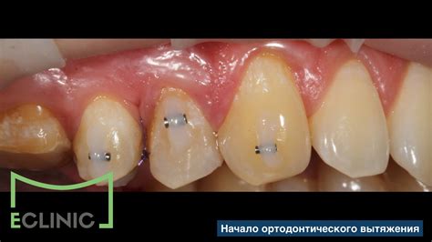 Пример по частичному ортодонтическому лечению, эндолечению, имплантации ...