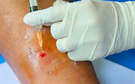 Incision And Drainage Limited Incisional Drainage And