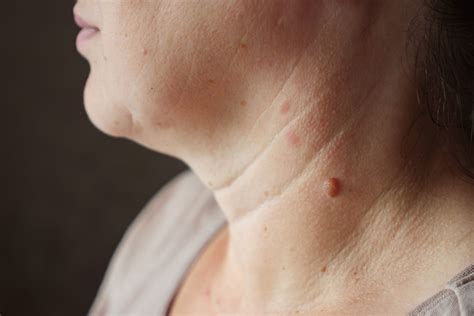 Wart Removal - Plant City Dermatology