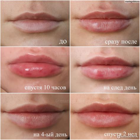 Филлер для губ Juvederm Ultra Smile - «Заезженный Juvederm Ultra Smile ...