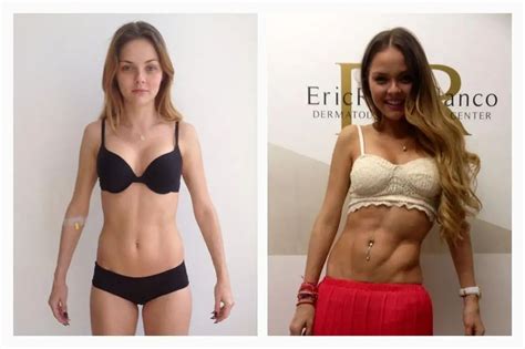 Abdomen Slim Láser - Dr. Eric Rojas - Dermatología Laser Center