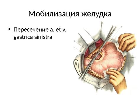 Резекция желудка по способу Бильрот 1 Анатомия