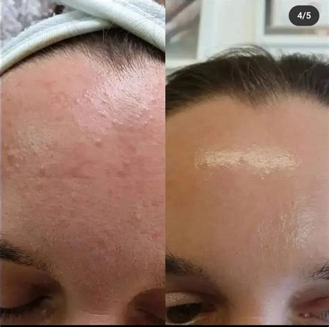 BioRePeel | DERMASPACE