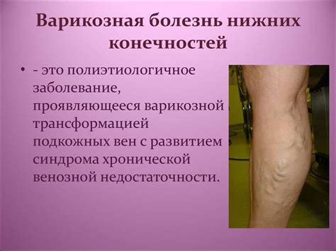 Варикозная болезнь нижних конечностей - презентация онлайн