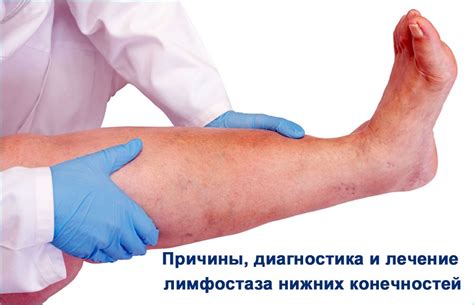 Причины, диагностика и лечение лимфостаза нижних конечностей