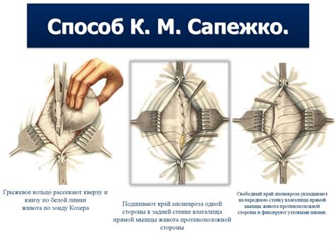 Классические методики оперативного лечения грыж передней брюшной стенки ...