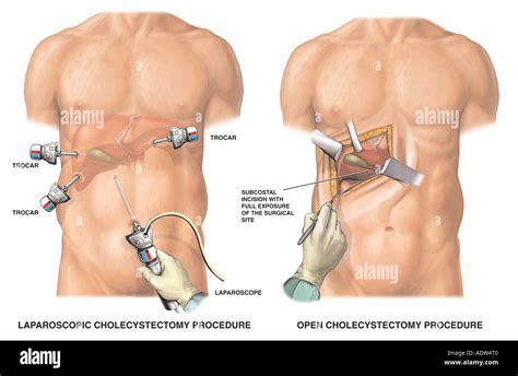 Laparoscopic Cholecystectomy Instruments Set at Marcus Goehring blog