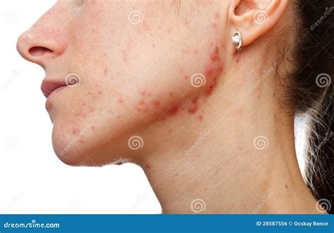Skin Problem With Acne Diseases, Close Up Woman Face With Whitehead Pimples On Mouth. Stock ...